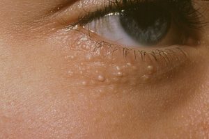 Milien und ihre Ursachen – Hausmittel gegen Milien